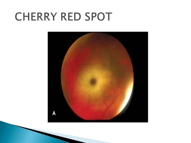 Retinal lesions Pathophysiology | PPT