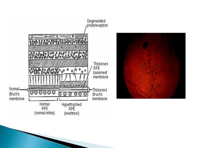 Retinal lesions Pathophysiology | PPT