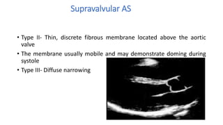 Pathophysiology aortic valve disease | PPTX