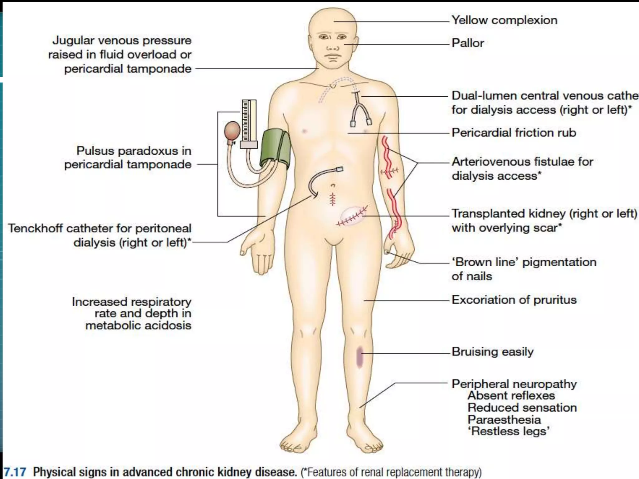 Pathophysiology arf. | PPTX