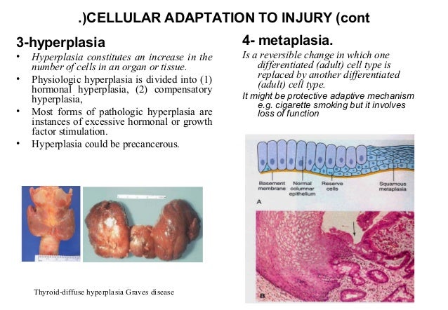 Pathophysiology ch 01 introduction, cell injury, adaptaion, death v2