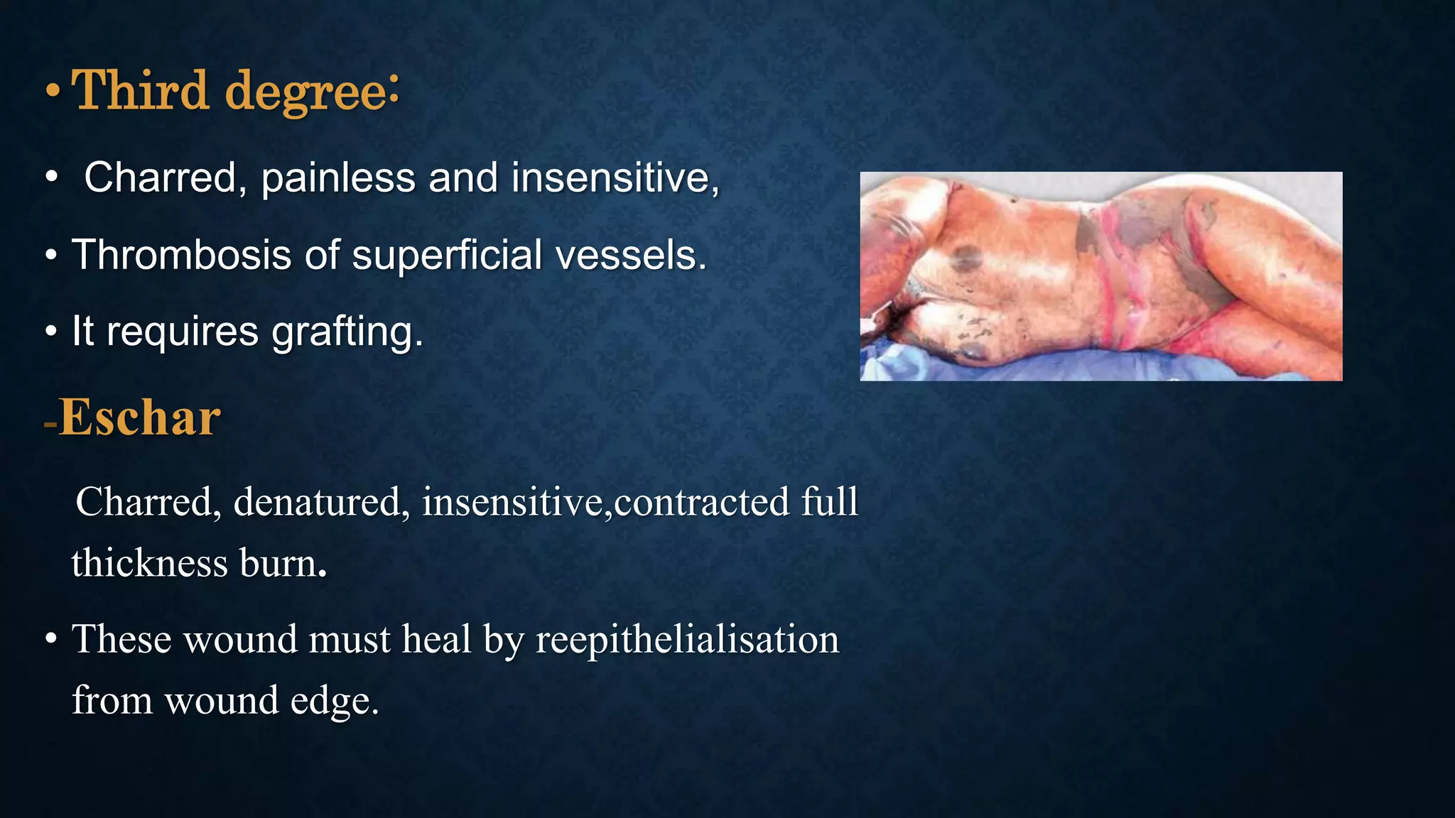 Pathophysiology and complications of burn | PPTX