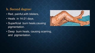 Pathophysiology and complications of burn | PPTX