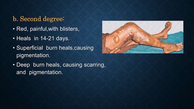Pathophysiology and complications of burn | PPTX | First Aid | Injuries