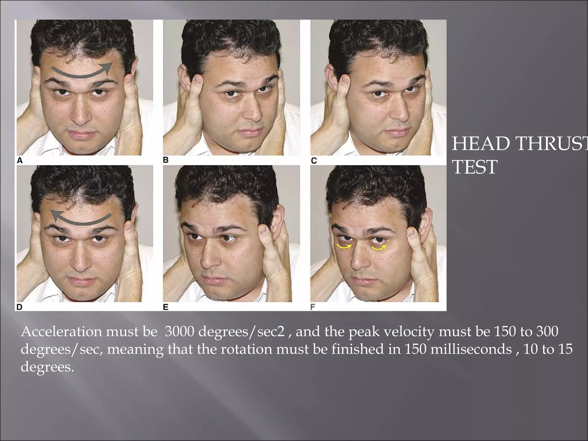 Pathophysiology of vestibular system | PPT