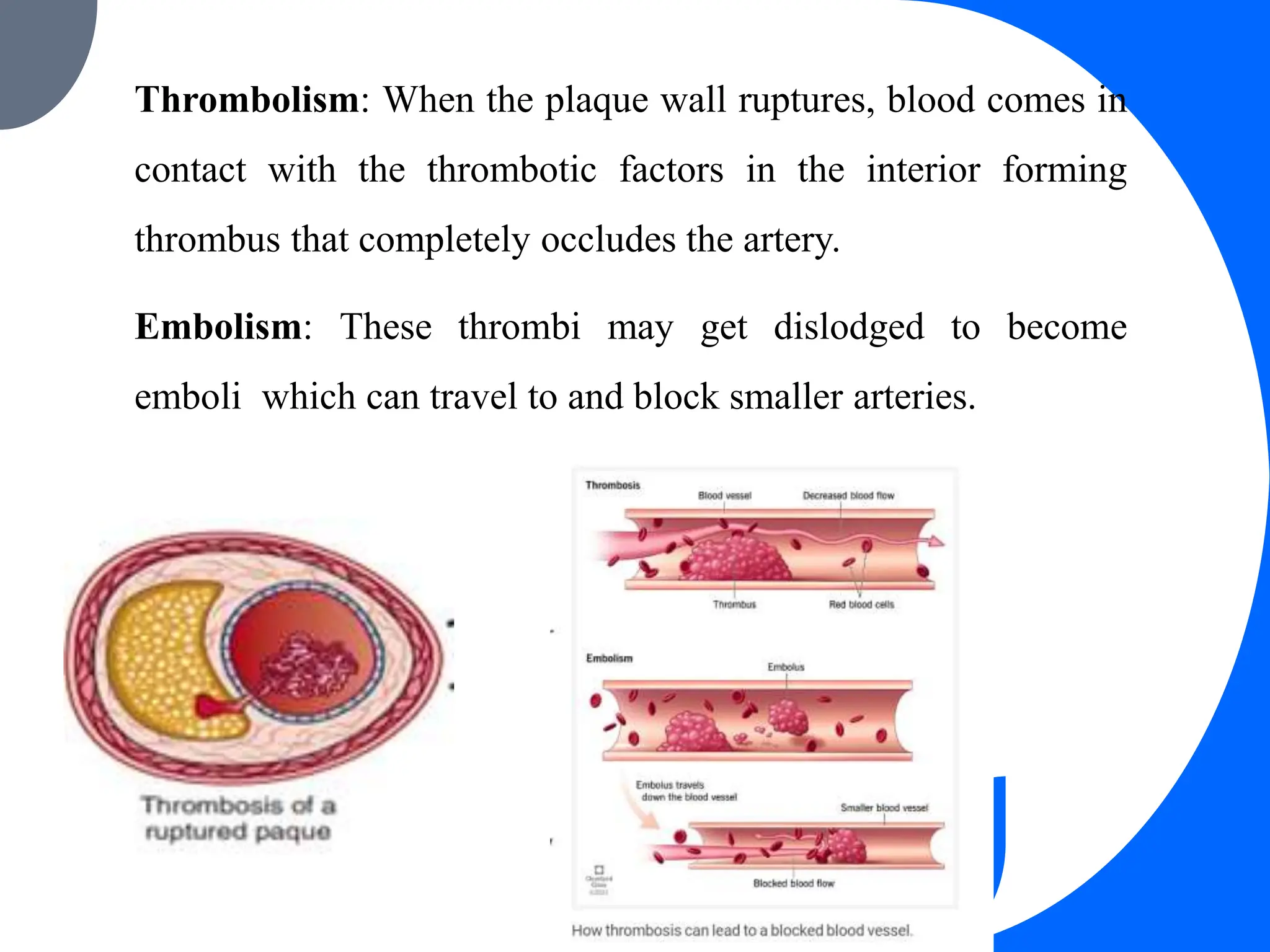 Pathophysiology of atherosclerosis.pptx