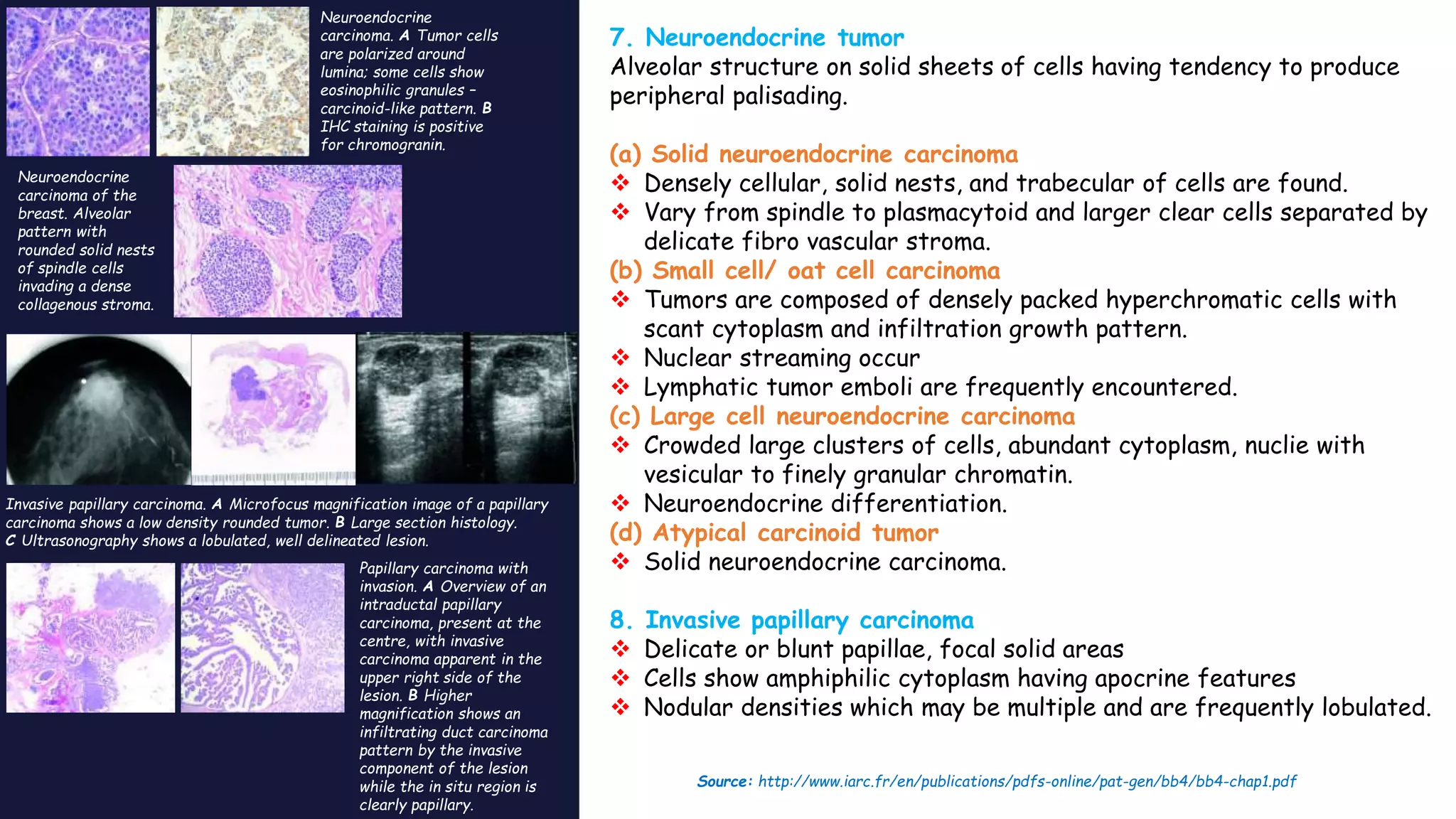 Pathophysiology of breast cancer | PPTX