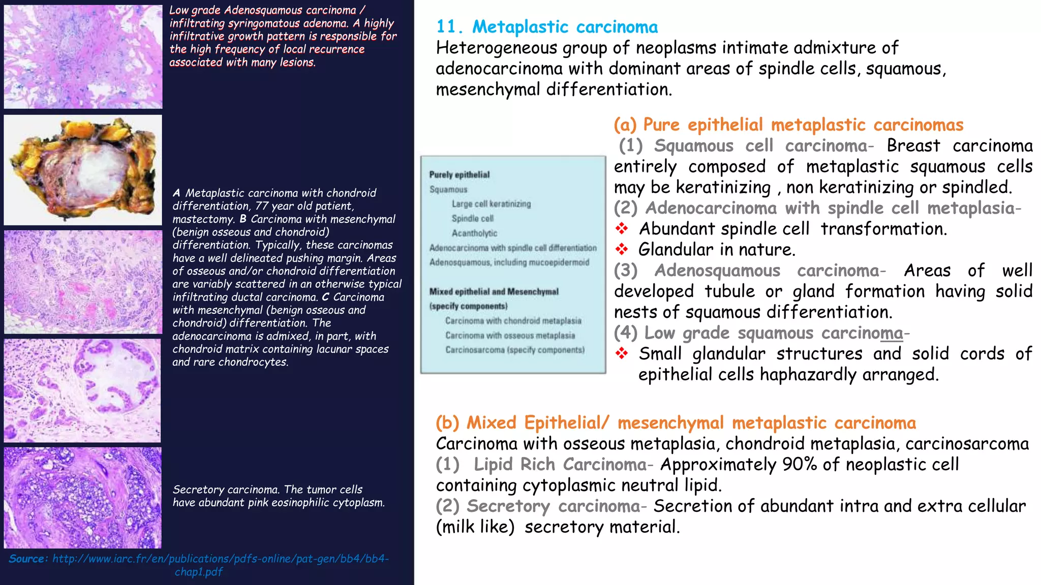 Pathophysiology of breast cancer | PPTX