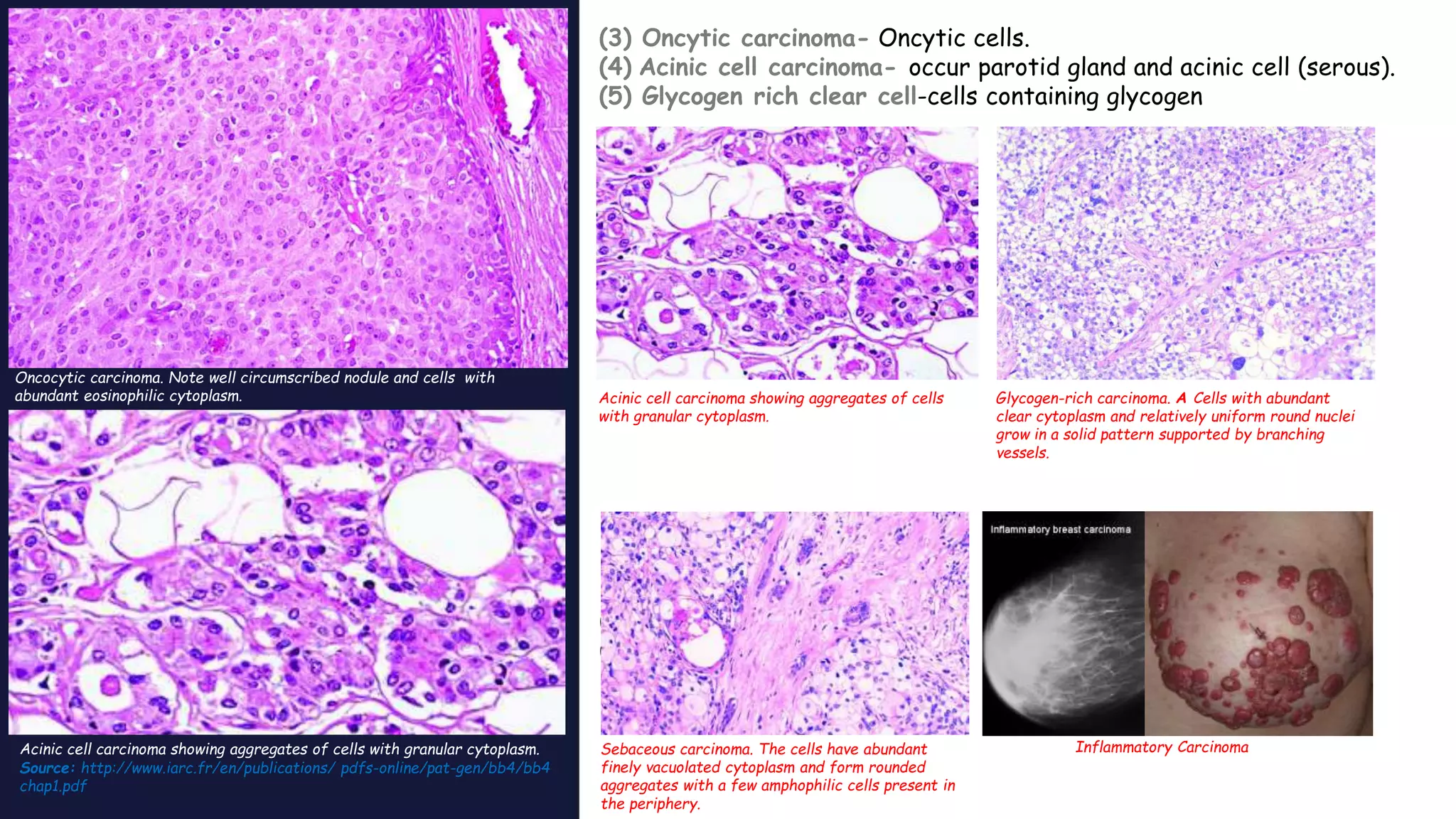 Pathophysiology of breast cancer | PPTX