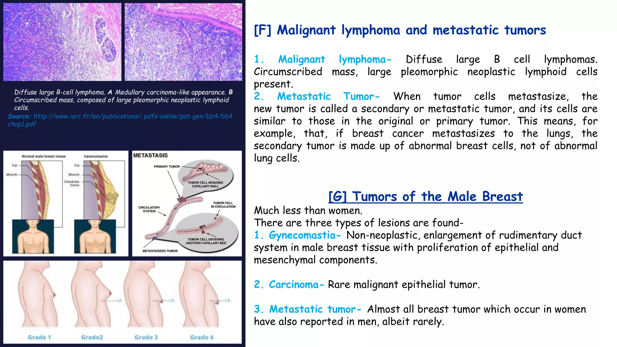 Pathophysiology of breast cancer | PPTX