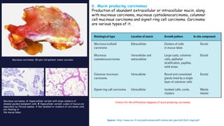 Pathophysiology of breast cancer | PPTX