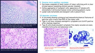 Pathophysiology of breast cancer | PPTX