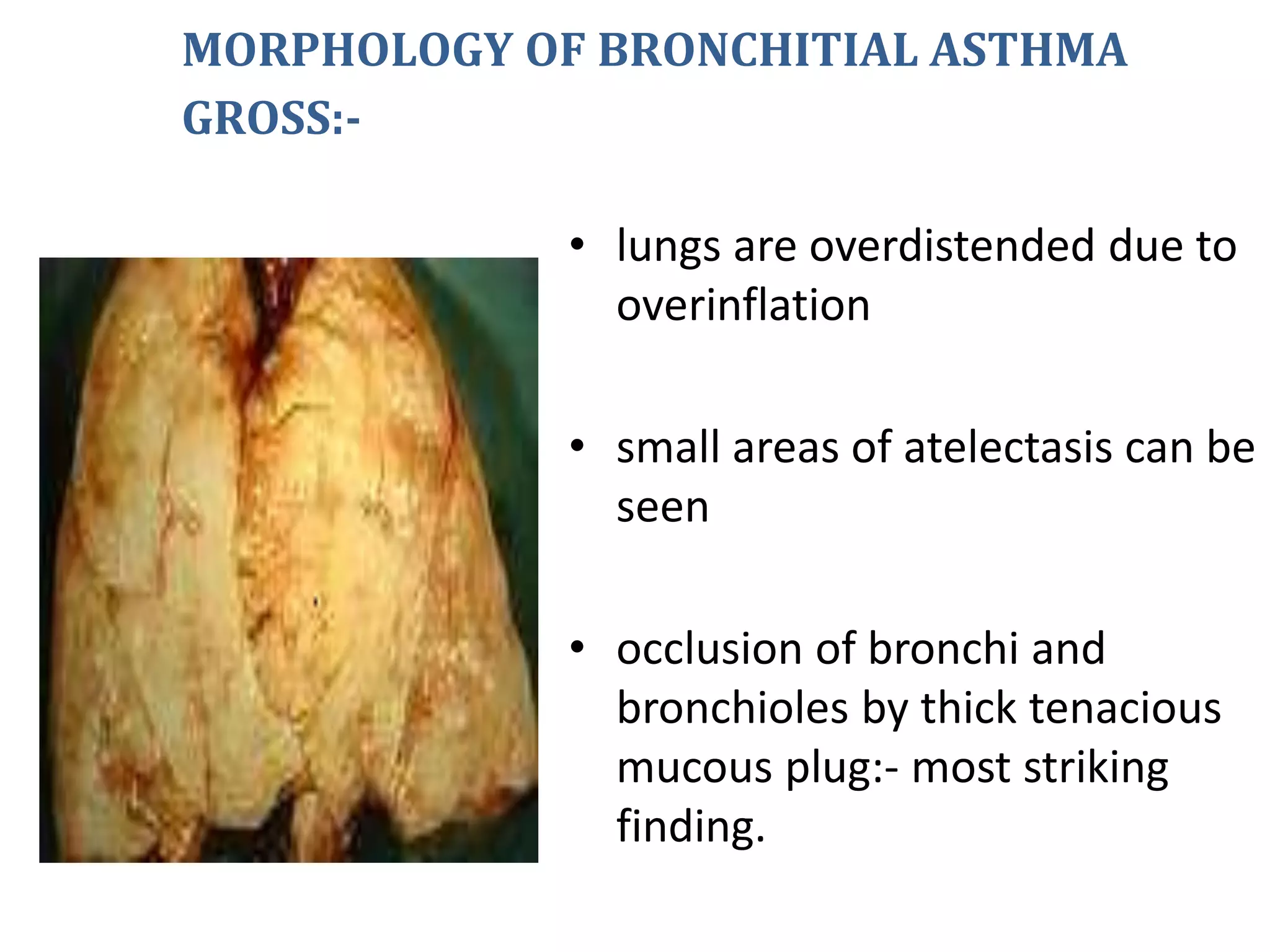 Pathophysiology of bronchial asthma f | PPTX