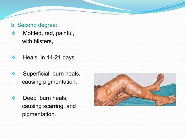 Pathophysiology of burns