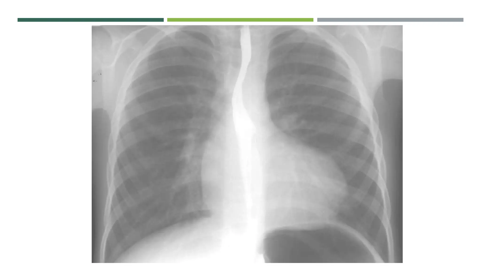 PATHOPHYSIOLOGY OF CONGENITAL CYANOTIC HEART DISEASE (2).pptx