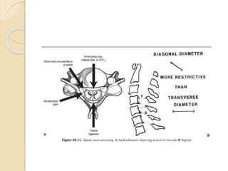 Pathophysiology of csm.pptx