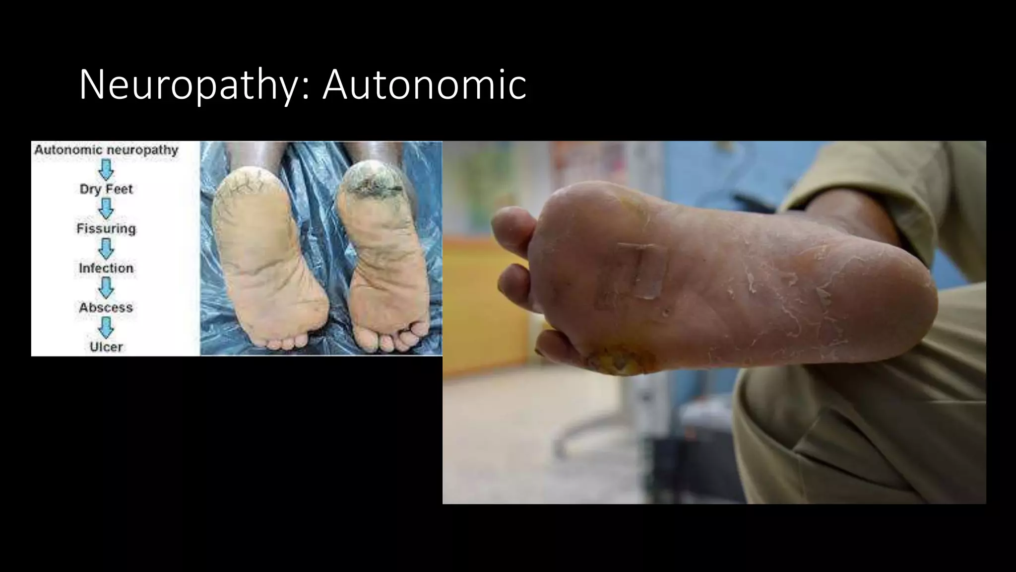 Pathophysiology of DFU.pptx
