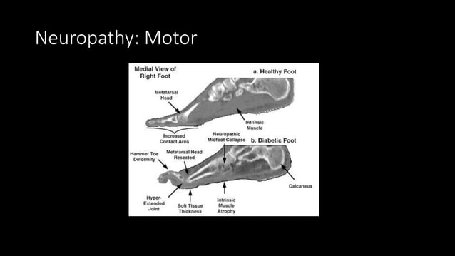 Pathophysiology of DFU.pptx | Diabetes | Diseases and Conditions