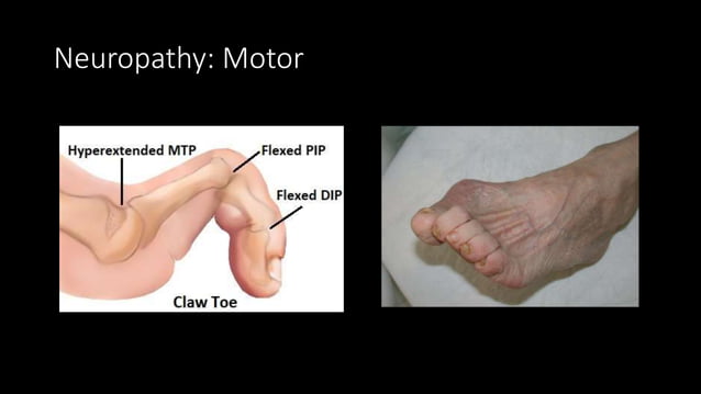 Pathophysiology of DFU.pptx | Diabetes | Diseases and Conditions