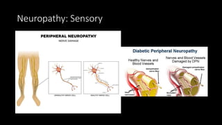 Pathophysiology of DFU.pptx