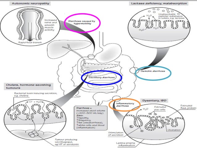 Pathophysiology of diarrhea | PPT | Digestive Disorders | Diseases and ...