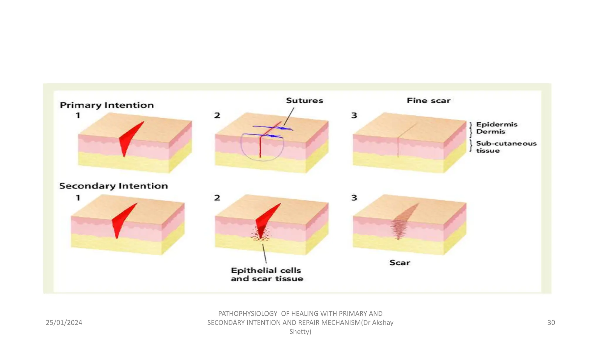 PATHOPHYSIOLOGY OF HEALING WITH PRIMARY & SECONDARY INTENTION.pptx