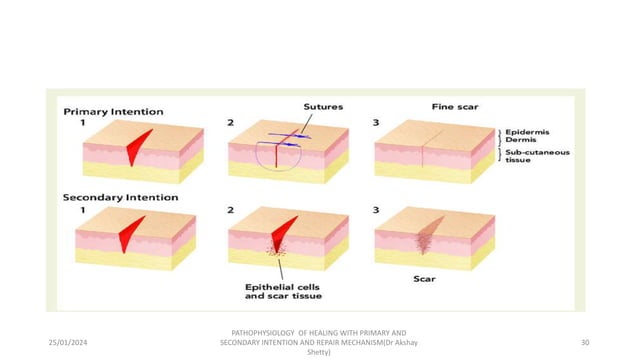 PATHOPHYSIOLOGY OF HEALING WITH PRIMARY & SECONDARY INTENTION.pptx ...