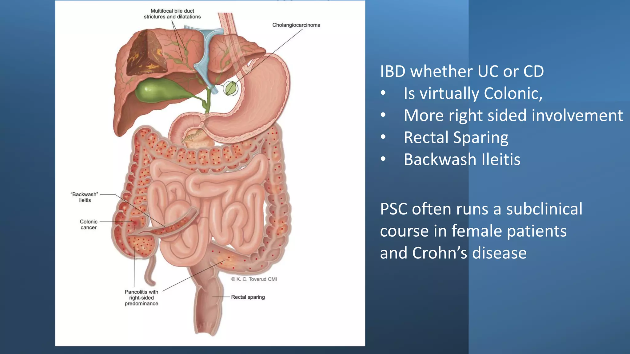 Pathophysiology of Hepatobiliary Menifestation of IBD.pptx