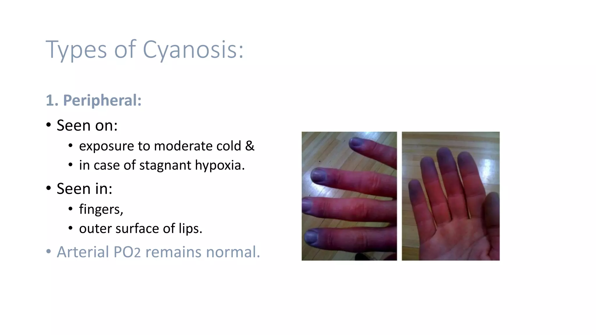 Pathophysiology of hypoxia and cyanosis.pptx
