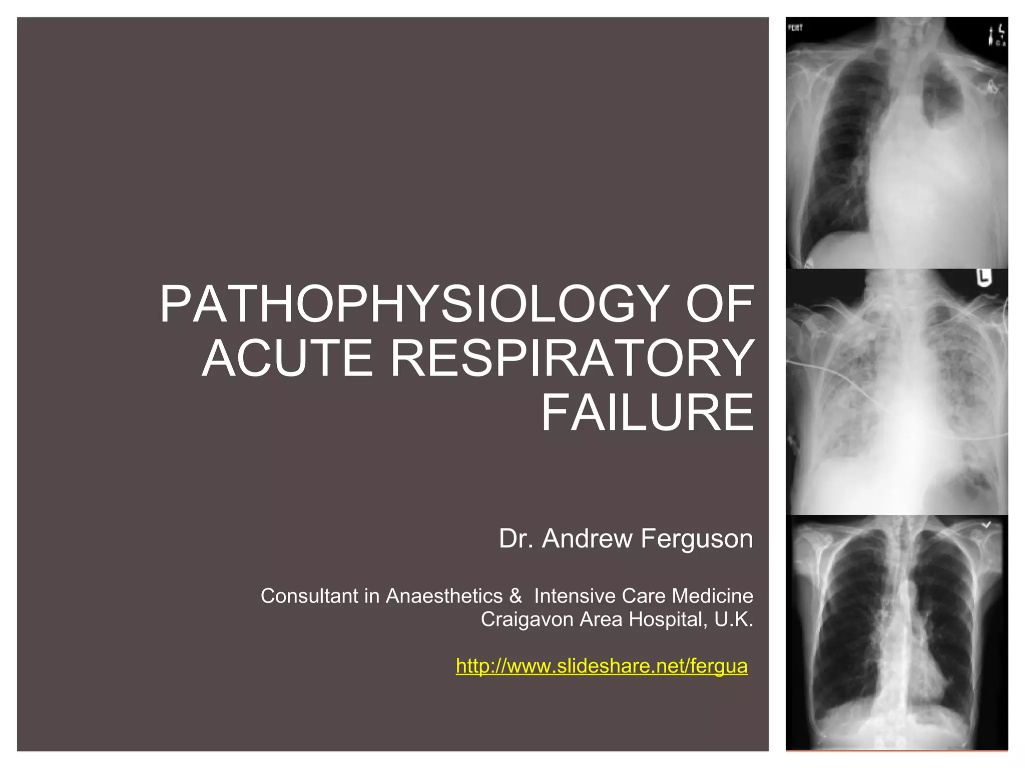 Pathophysiology of hypoxic respiratory failure | PPT