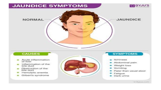 pathophysiology of jaundice by anup kumar dash.pptx