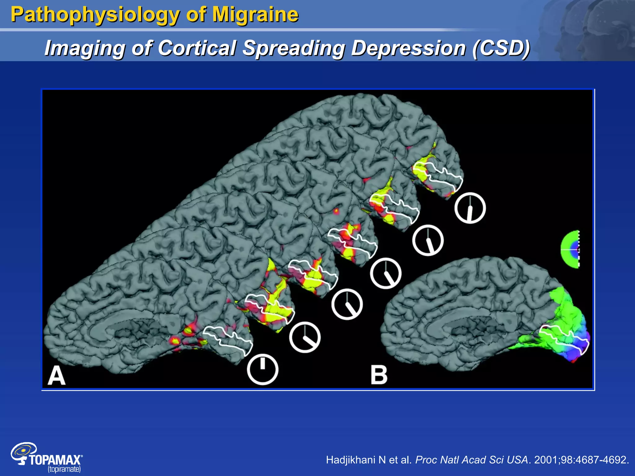 Pathophysiology of migraine | PPT