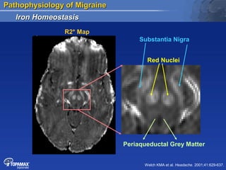 Pathophysiology of migraine | PPT
