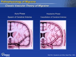 Pathophysiology of migraine | PPT