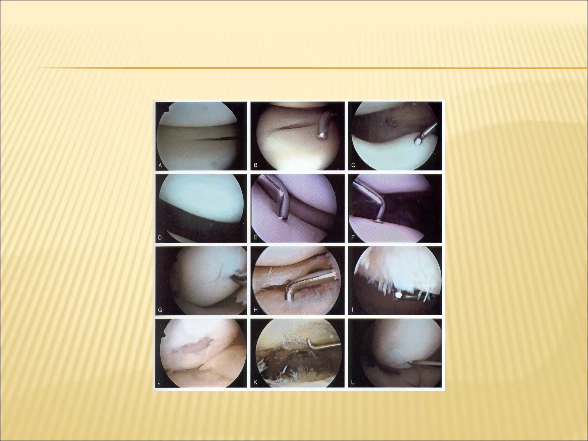 Pathophysiology+of+Osteoarthritis | PPT