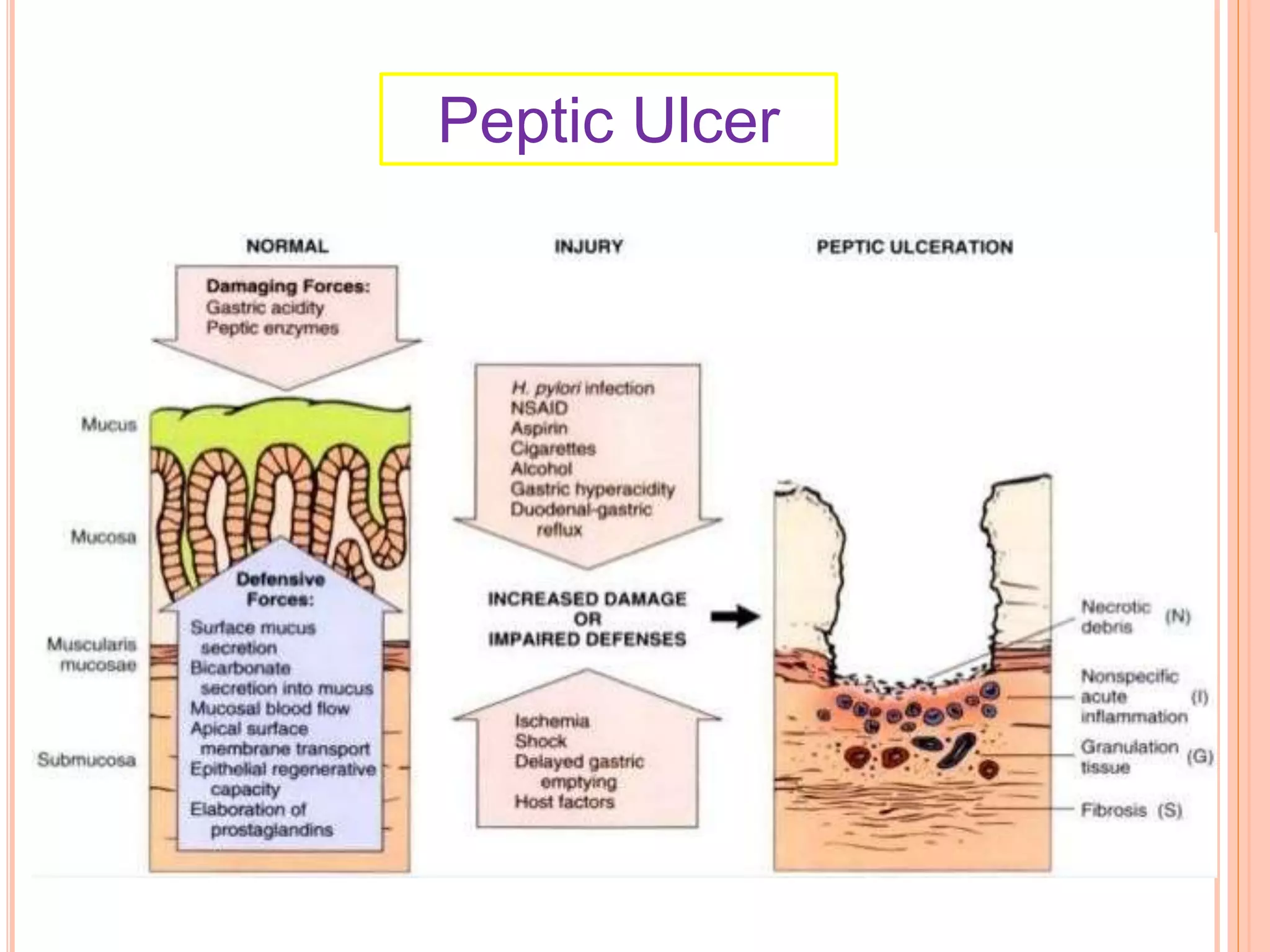 Pathophysiology of peptic ulcer | PPTX