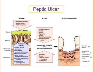 Pathophysiology of peptic ulcer | PPTX
