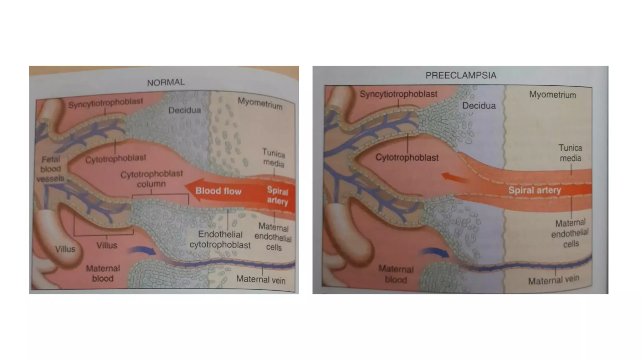 Pathophysiology of pregnancy induced hypertension | PDF