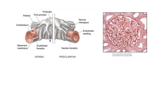 Pathophysiology of pregnancy induced hypertension | PDF