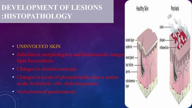 recent advances in the pathophysiology of psoriasis | PPT