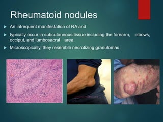 Pathophysiology of Rheumatoid Arthritis | PPTX