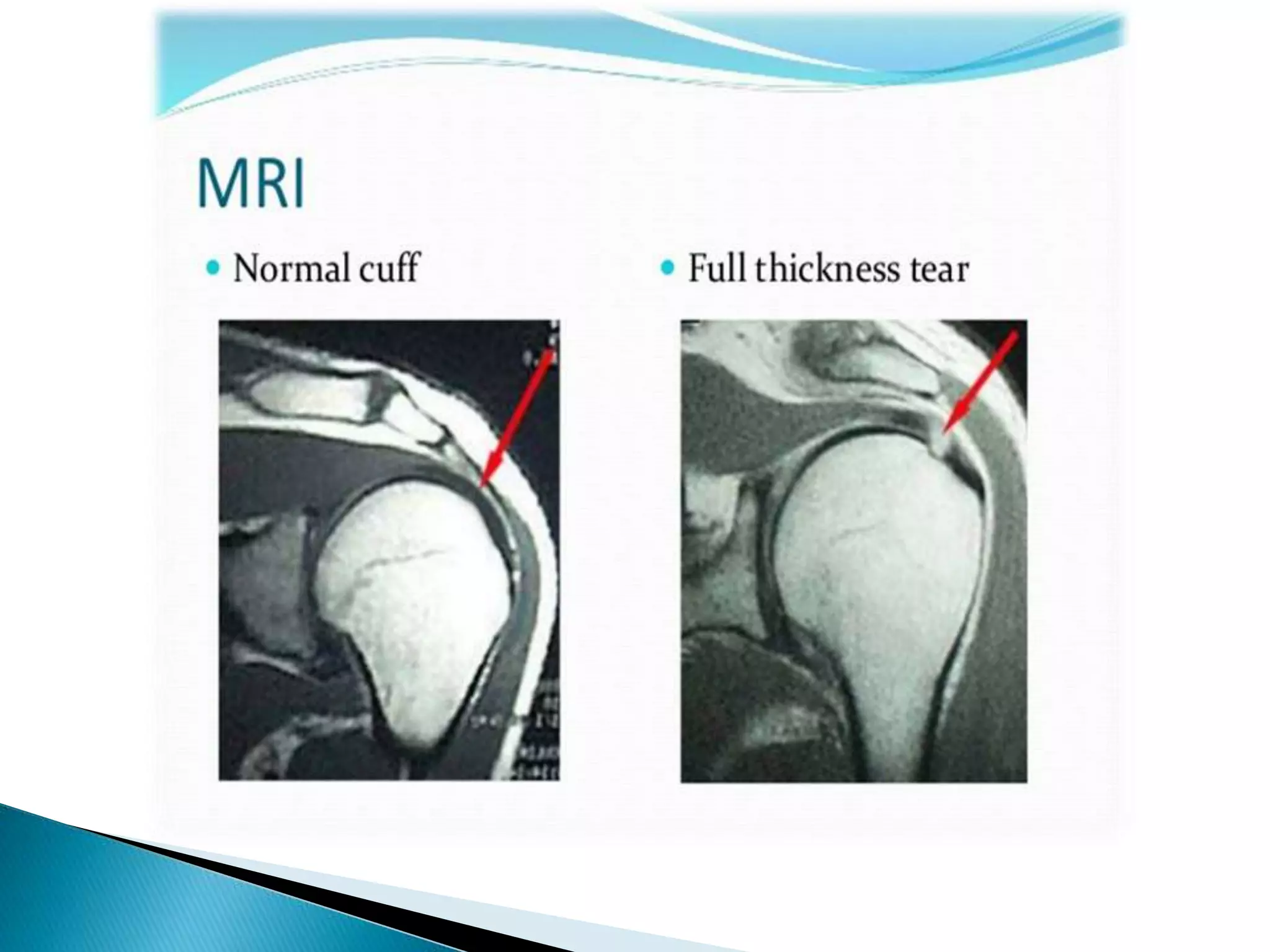 Pathophysiology of shoulder rotator cuff instability and repair | PPT