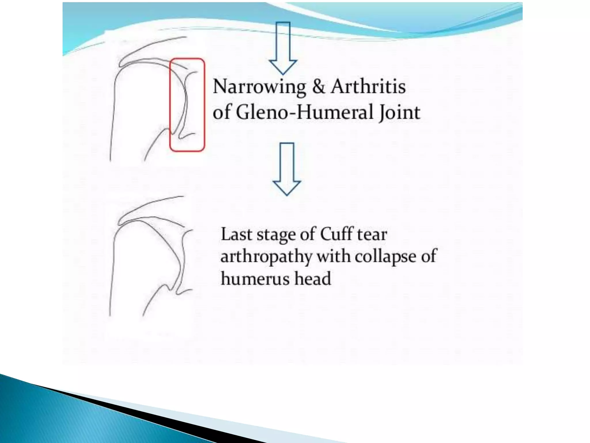 Pathophysiology of shoulder rotator cuff instability and repair | PPT