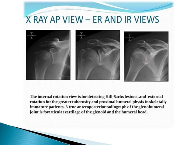 Pathophysiology of shoulder rotator cuff instability and repair | PPT
