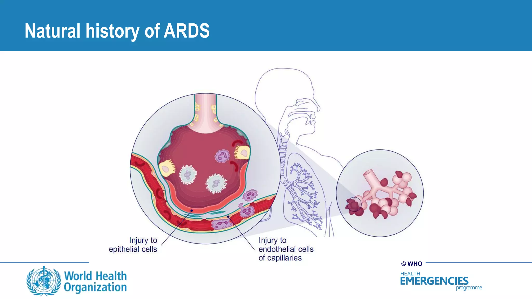 Pathophysiology of sepsis and ARDS.pptx