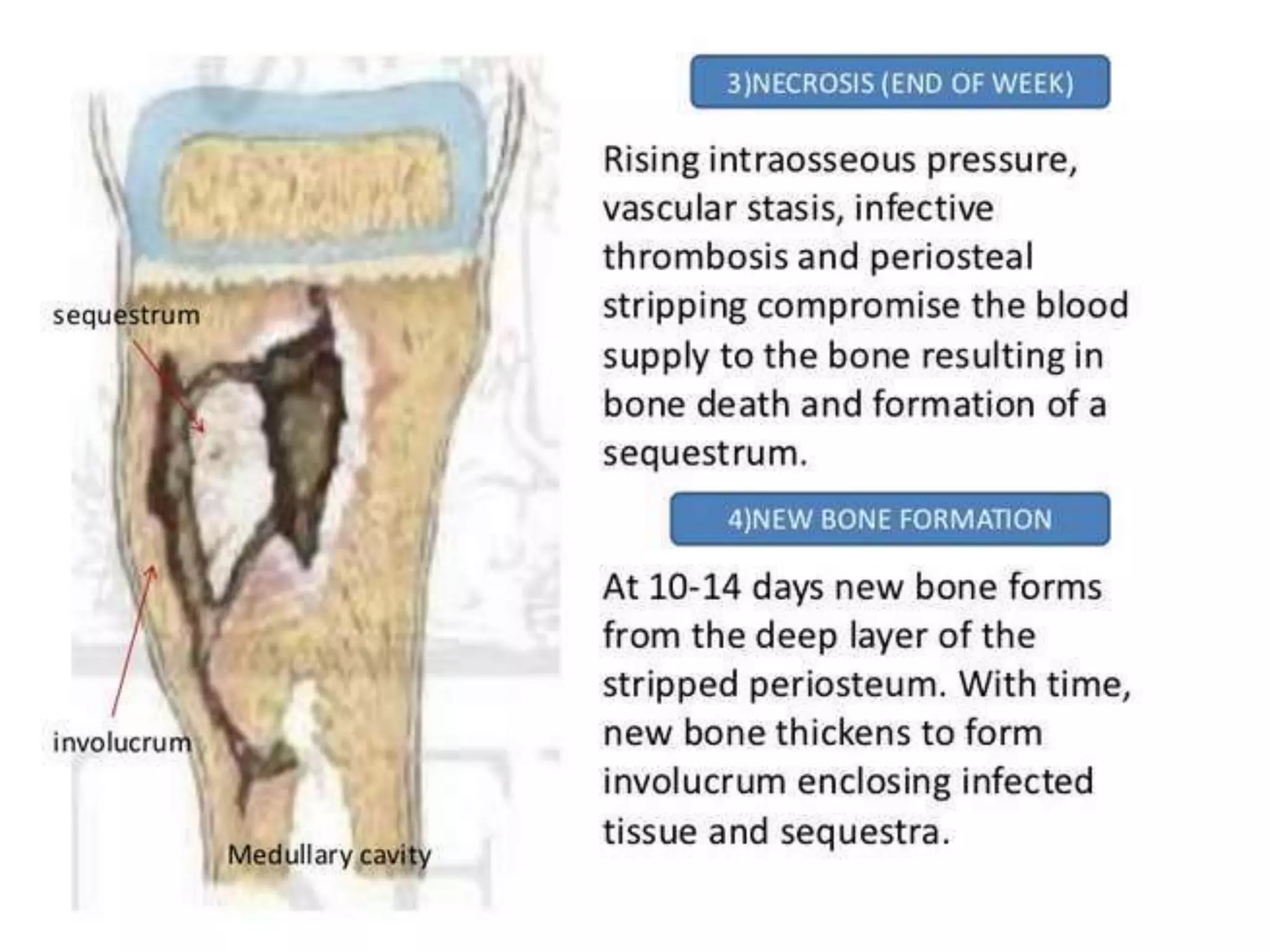 PATHOPHYSIOLOGY OF SEQUESTRUM.pptx