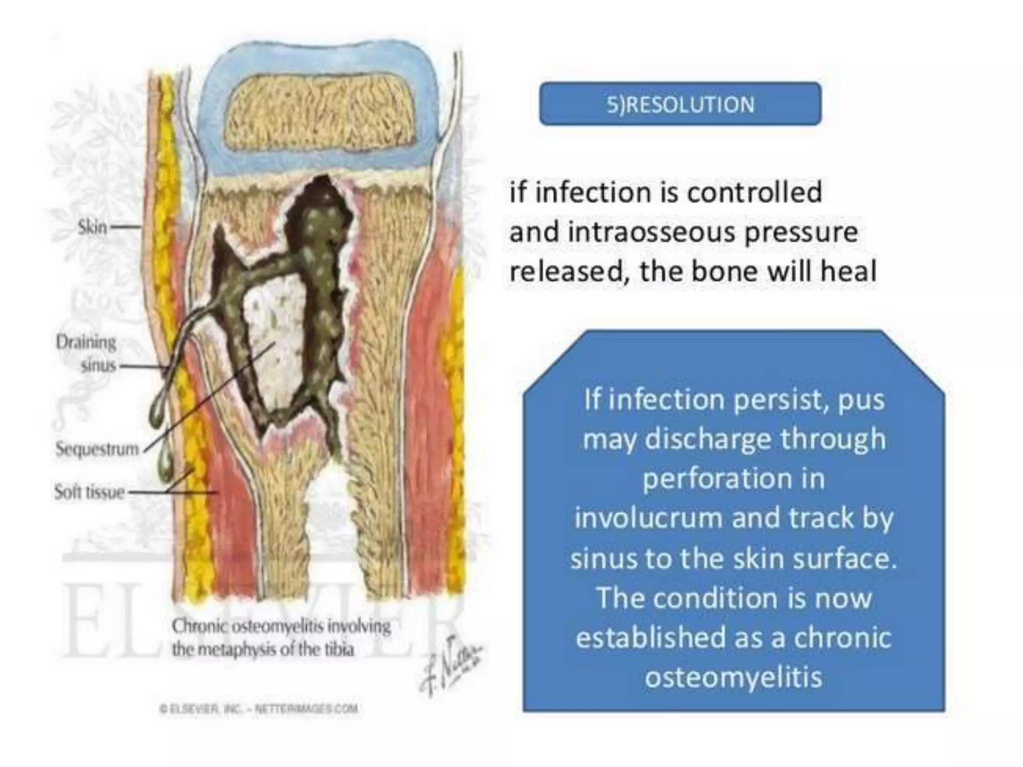 PATHOPHYSIOLOGY OF SEQUESTRUM.pptx