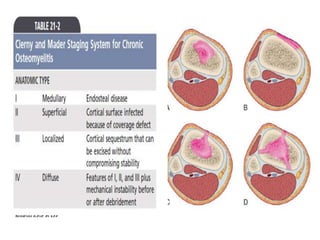 PATHOPHYSIOLOGY OF SEQUESTRUM.pptx