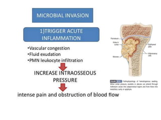 PATHOPHYSIOLOGY OF SEQUESTRUM.pptx