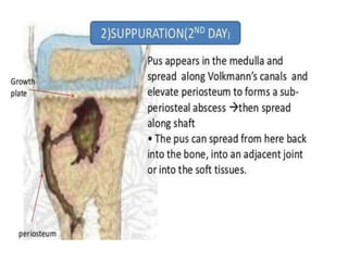 PATHOPHYSIOLOGY OF SEQUESTRUM.pptx